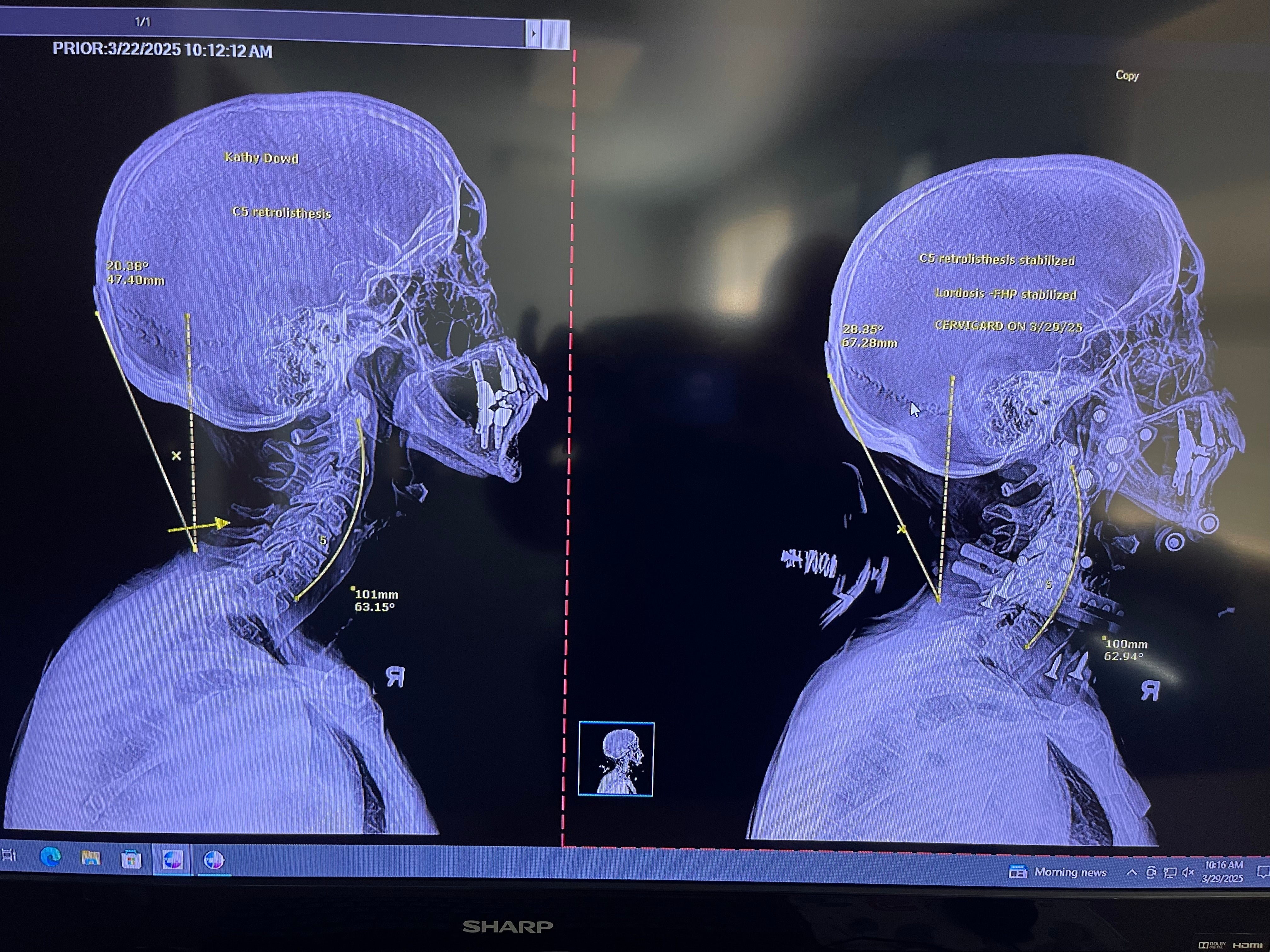 Four phases of FHP – Cervigard