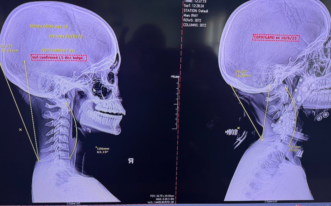 Case study - 15 year old soccer player with disabling sciatica – Cervigard